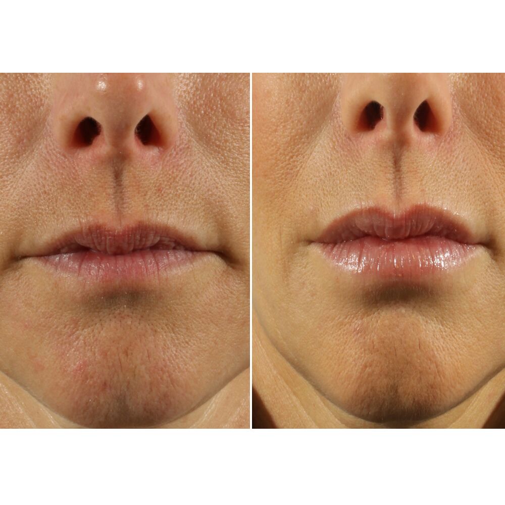 The Best Lip Enhancement Treatment for Every Age - NewBeauty