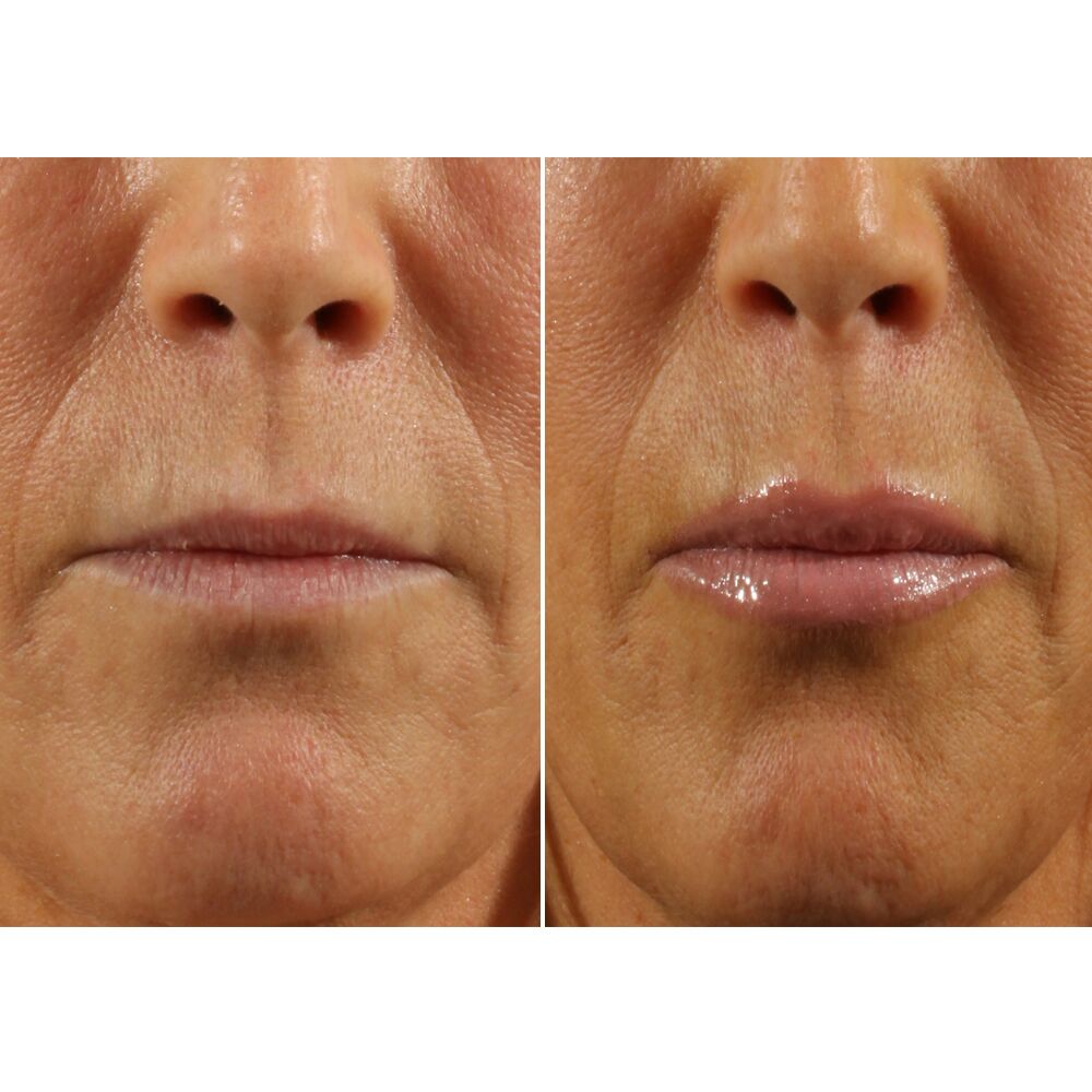 The Best Lip Enhancement Treatment for Every Age - NewBeauty