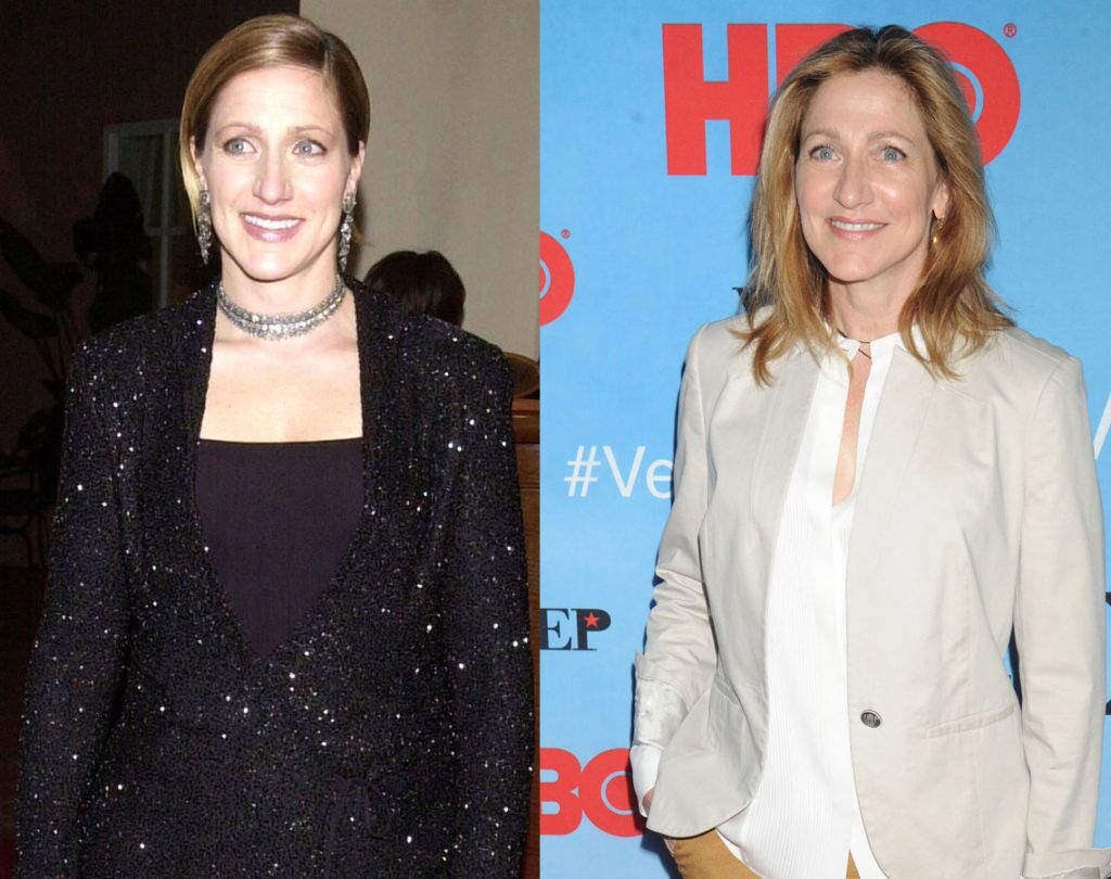 Edie Falco Plastic Surgery