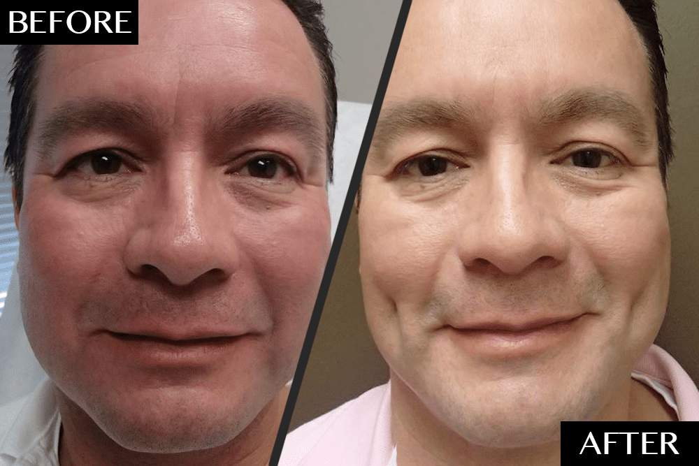 Exploring the Details of Dimpleplasty Surgery