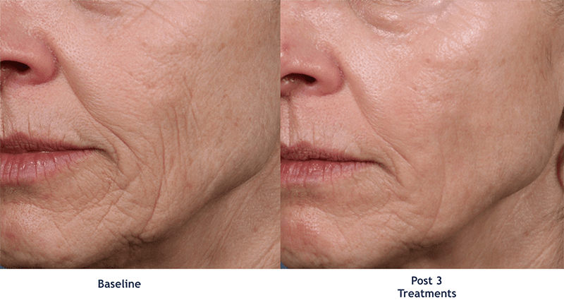 The New Nonsurgical Facelift: Can Dermal Micro-Coring Come Close to ...