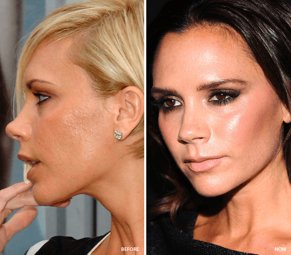 Celebrities With Bad Skin Texture