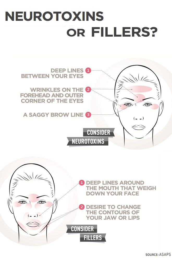 Infographic: Neurotoxins or Fillers? - NewBeauty