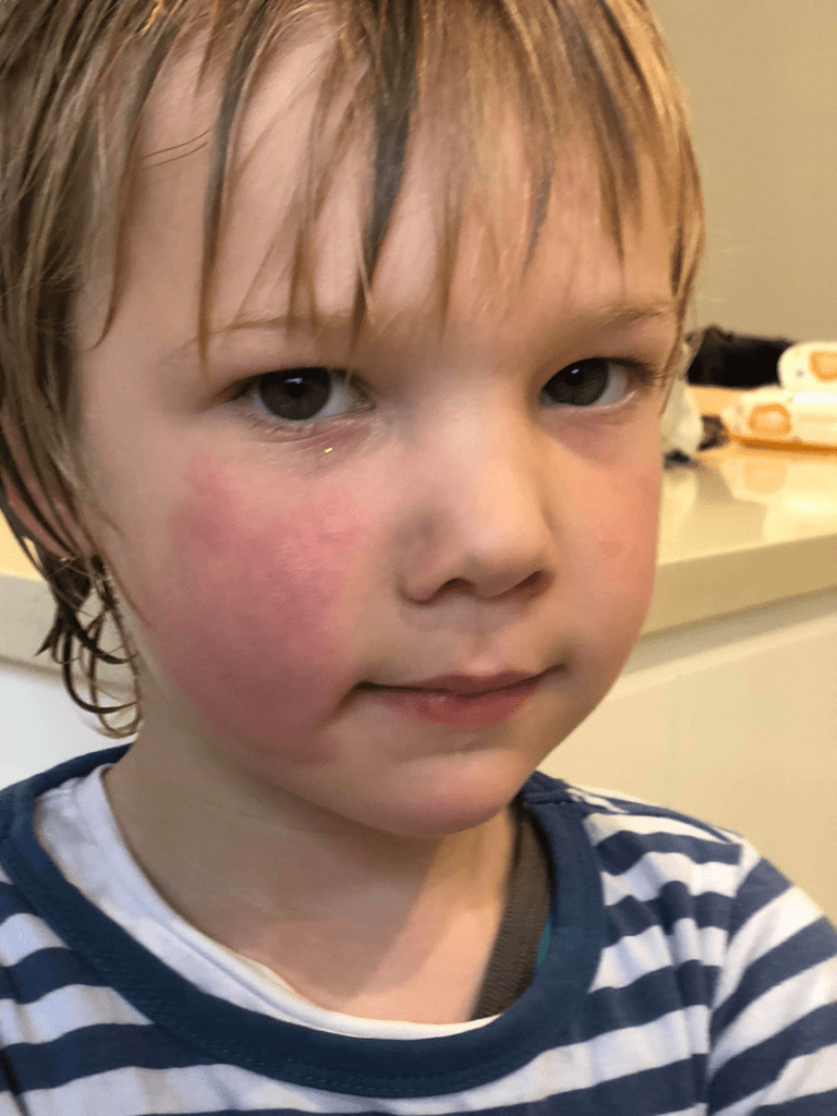 Concerned Mom Shares a Warning About Lip Plumper “Poison Kiss” - NewBeauty