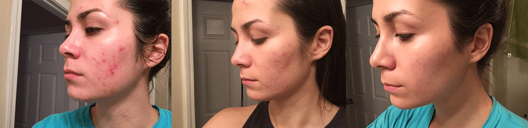 Dr. Dennis Gross's New Acne-Eliminating Gel Is the Only Product You ...