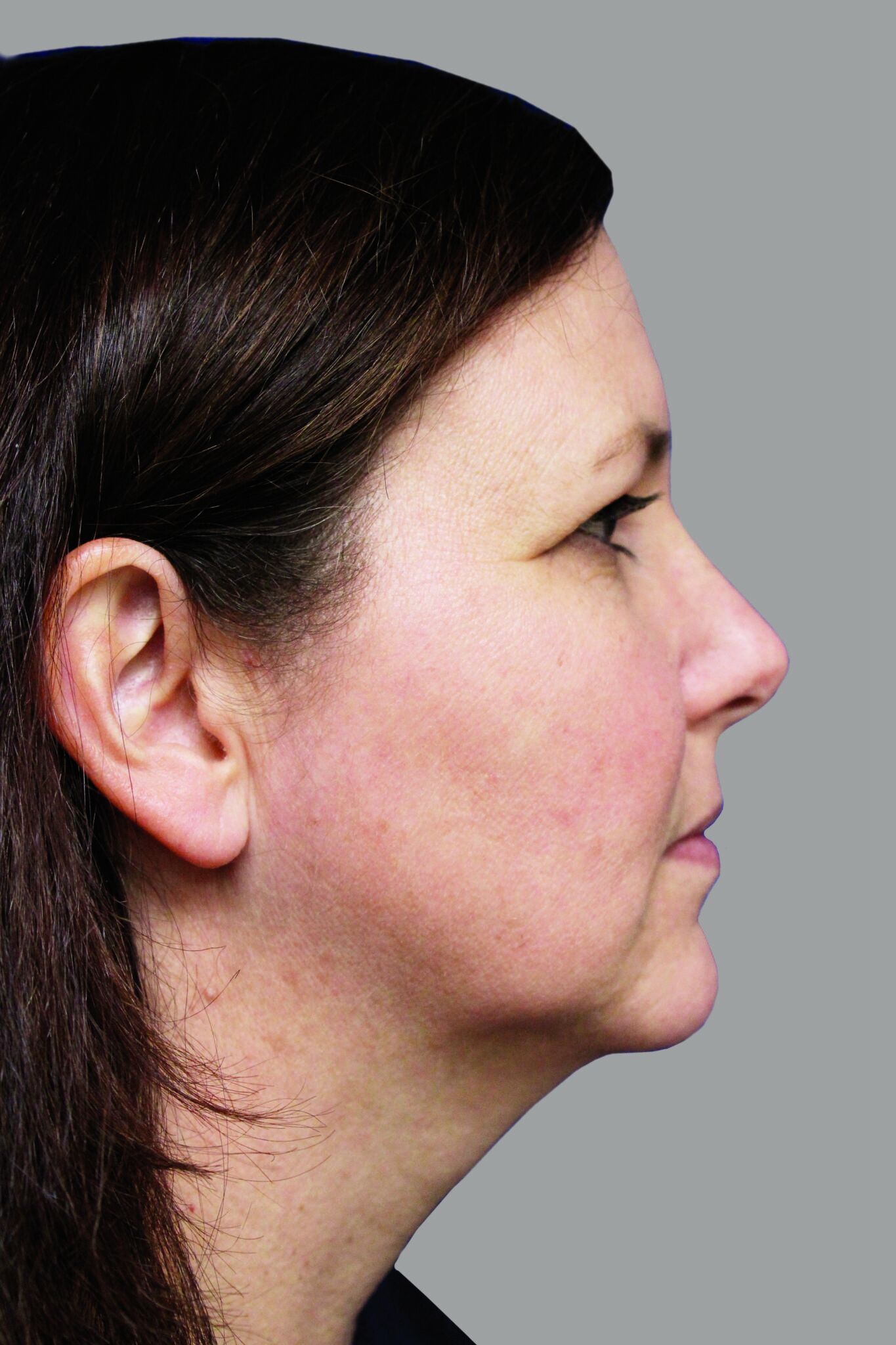 Chins Are The New Cheeks: Why Chin-Enhancing Options Are Trending ...