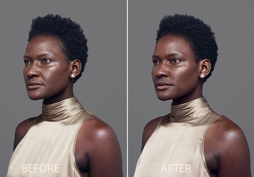 RHA 2, 3 , 4 and Redensity—What to Know about Revance's HA Fillers ...