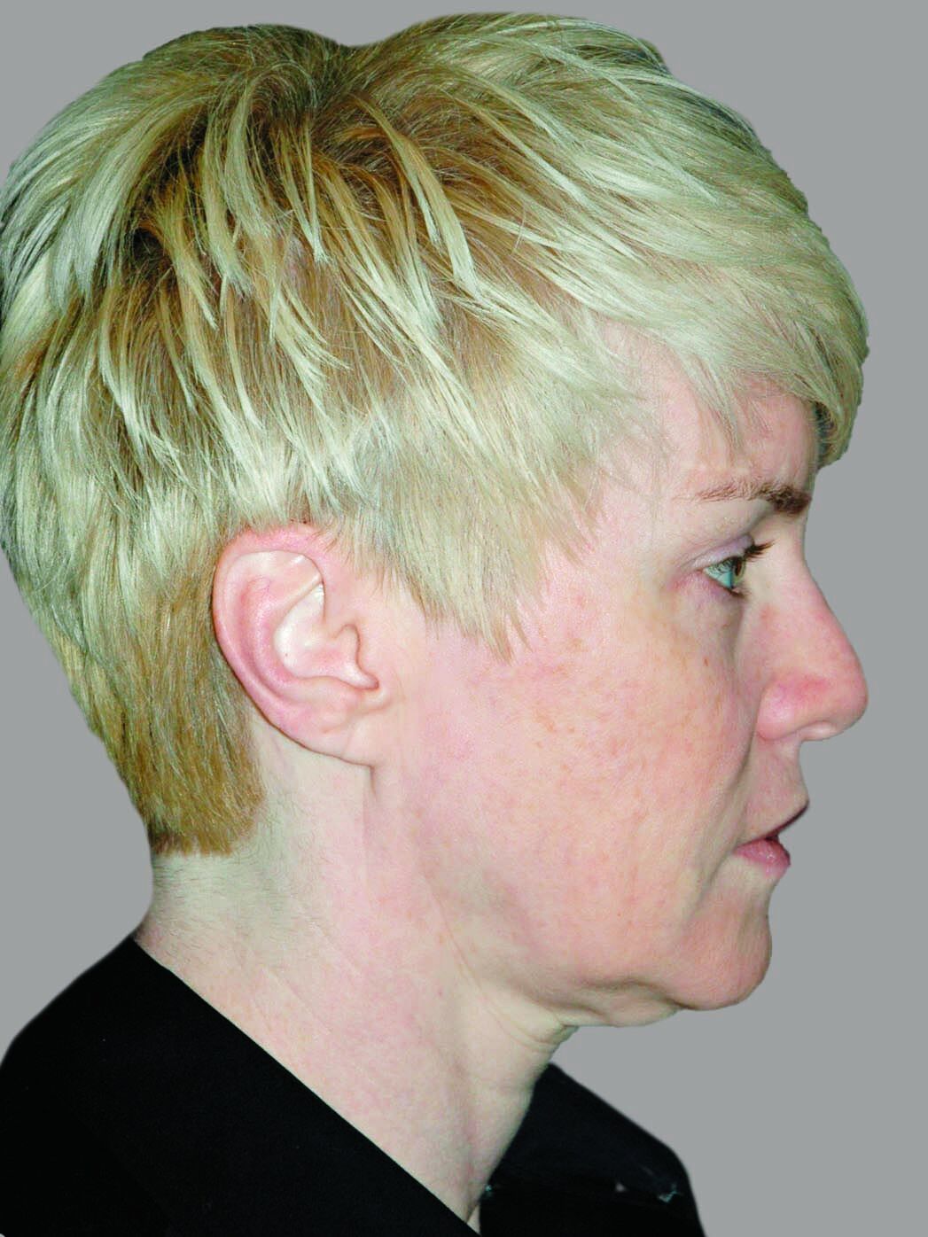 The Age-Defying Surgery Plastic Surgeons Say Has Had a 'Positive ...