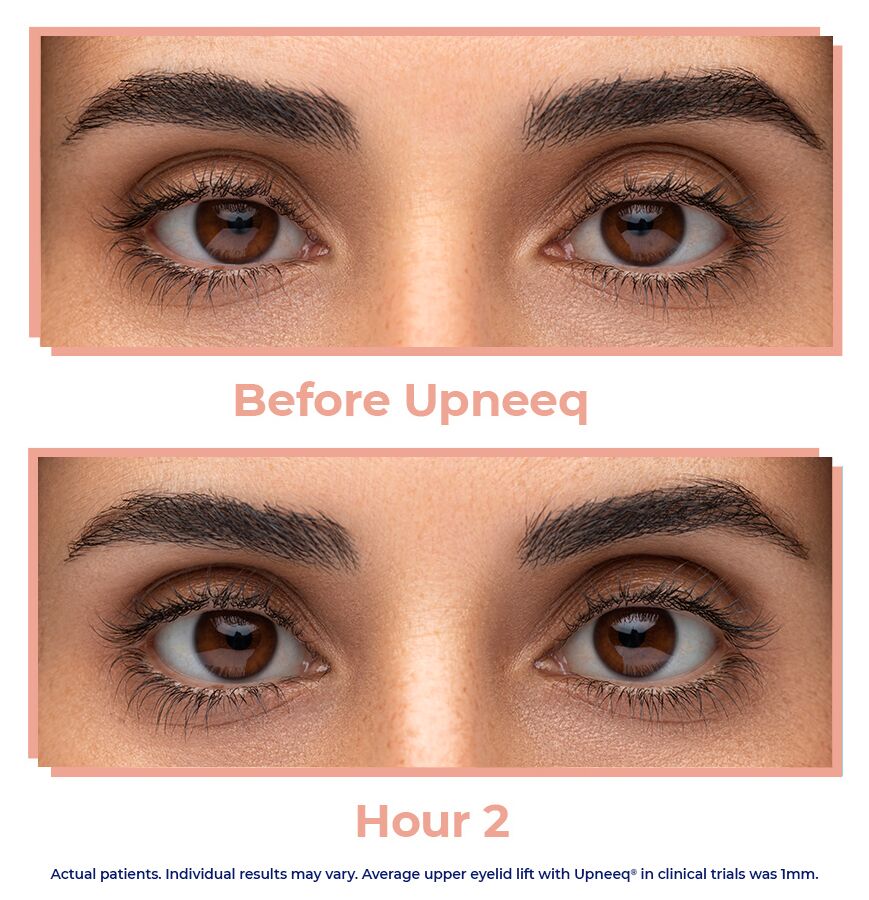 This New Eye Drop Lifts Droopy Eyelids Without Surgery - NewBeauty