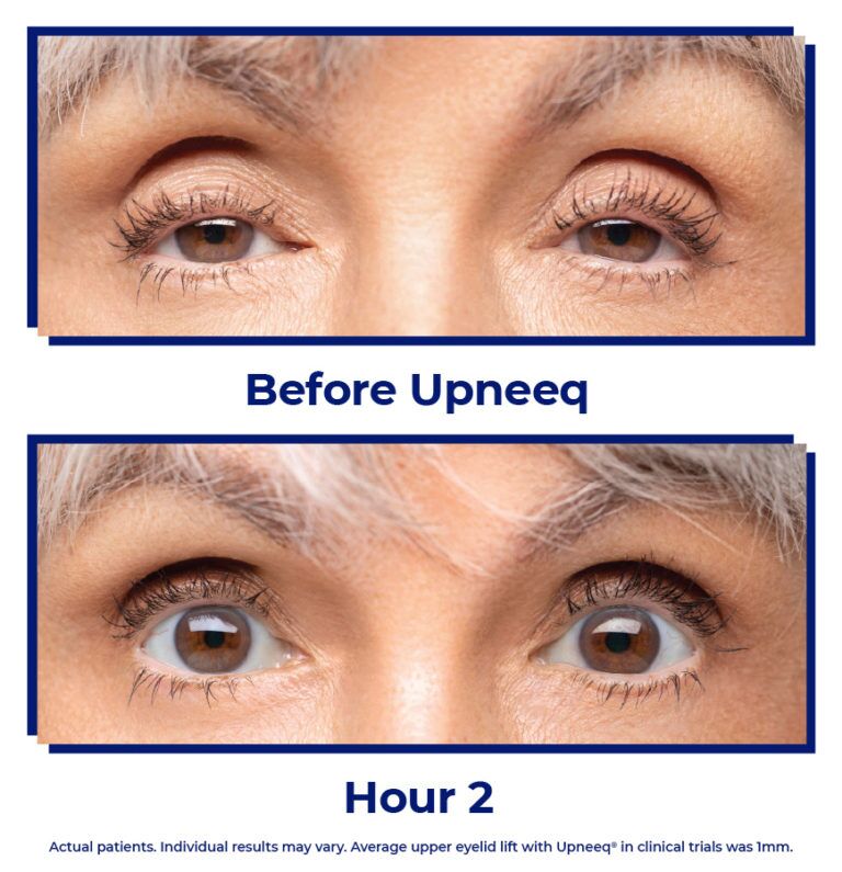 This New Eye Drop Lifts Droopy Eyelids Without Surgery - NewBeauty