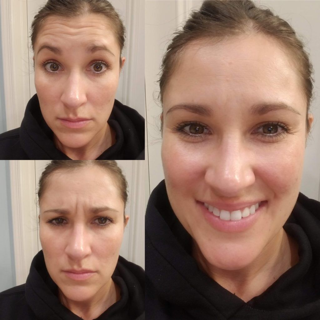 Botox Cosmetic at 40: Why I Waited Until Now and What It's Really Like ...