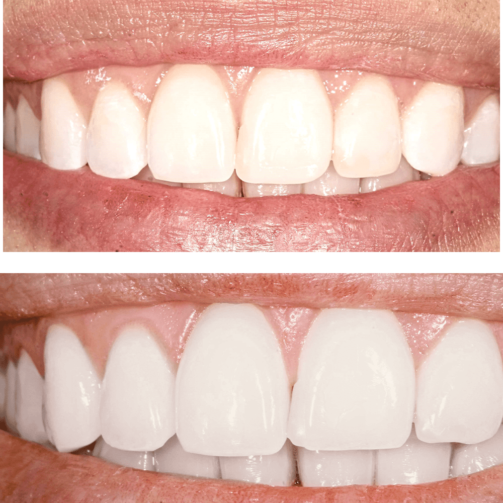 Dentists Reveal 5 Common Teeth-Staining Culprits - NewBeauty