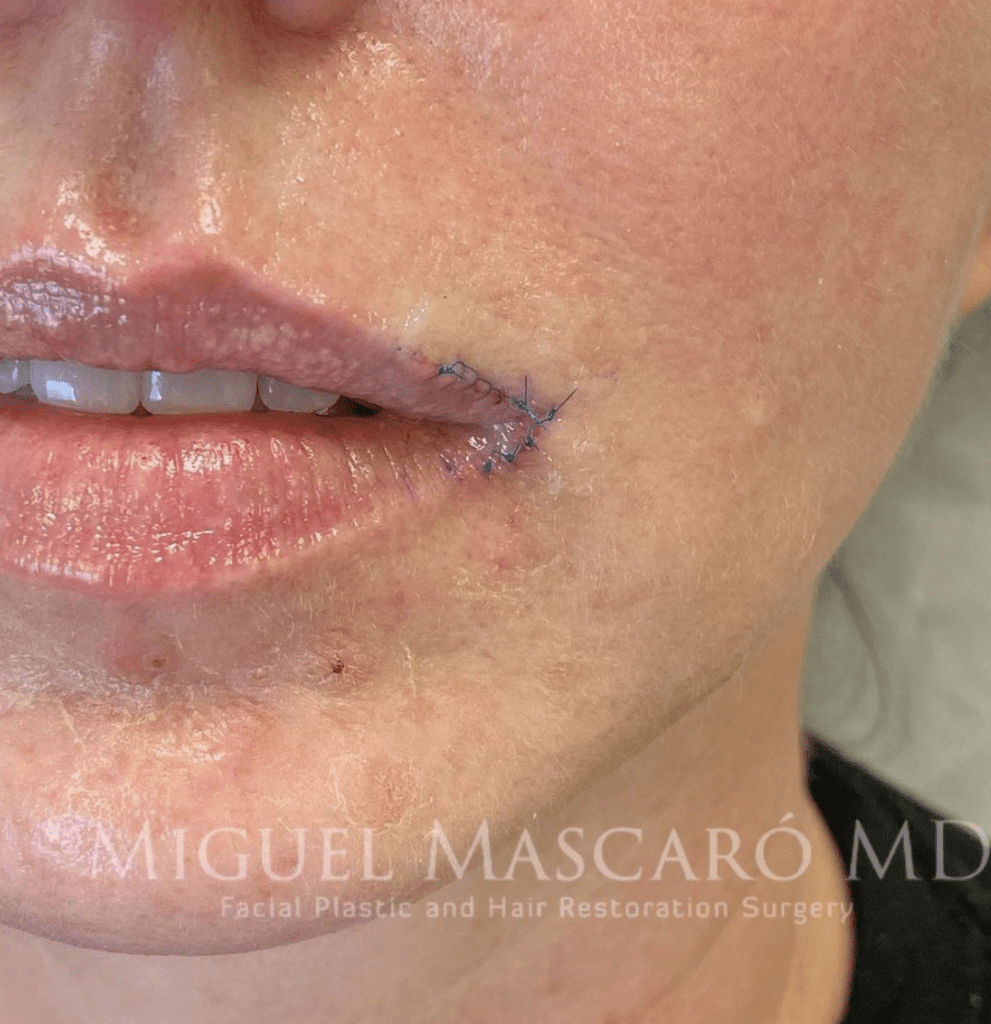 What You Need to Know About the Trending 'Corner Lip Lift' Treatment ...