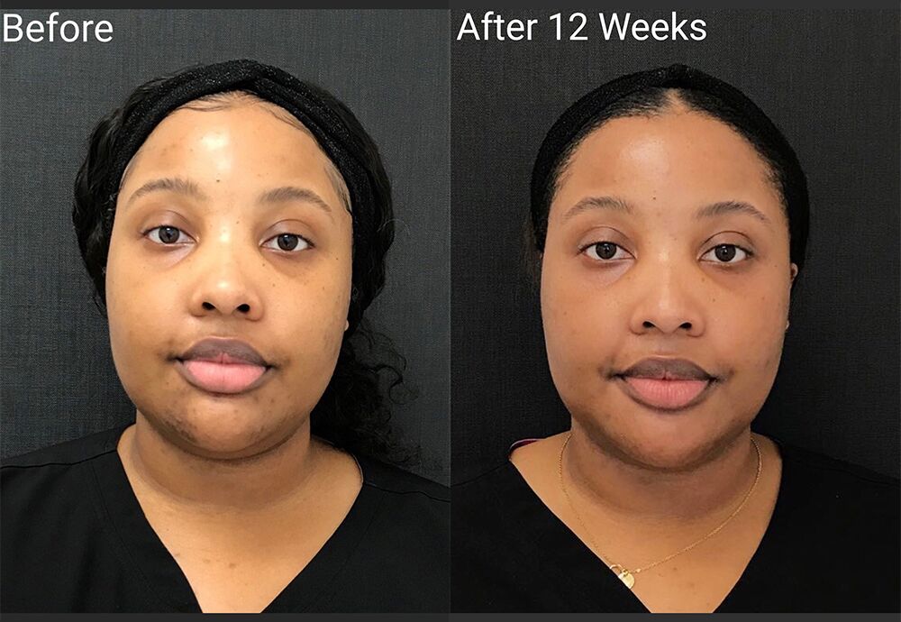 Melasma Mustache: How to Treat the Frustrating Hyperpigmentation