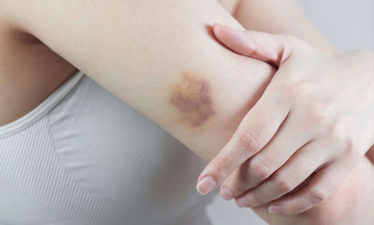 What It Means If You Bruise Easily - NewBeauty