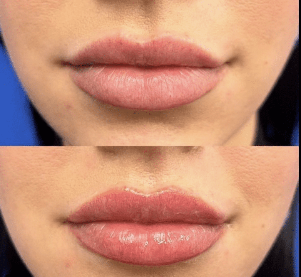 The "Laser Lip FIip" Is the New, Needle-Free Way to Plump Thin Lips