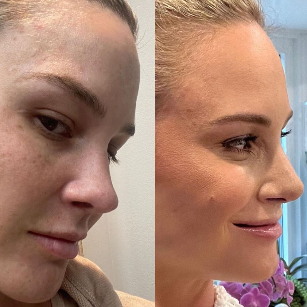 Megan Before Nose Job