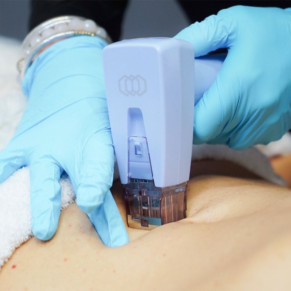 The Differences Between the Most Popular Radio-Frequency Microneedling ...