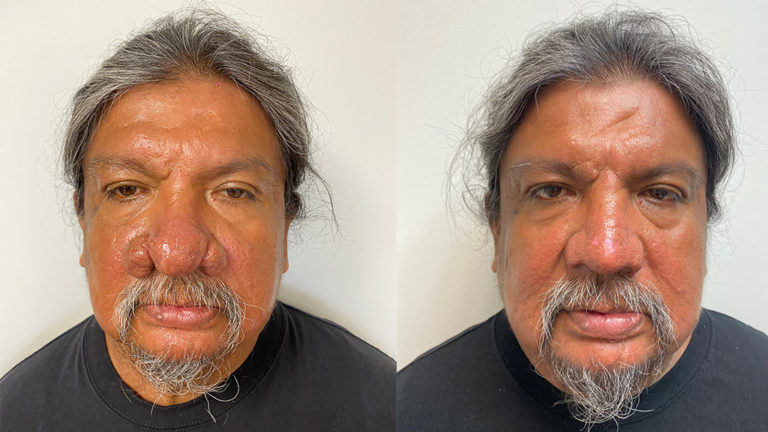 The Life-Changing Ways Doctors are Treating This Rare Nose Condition ...