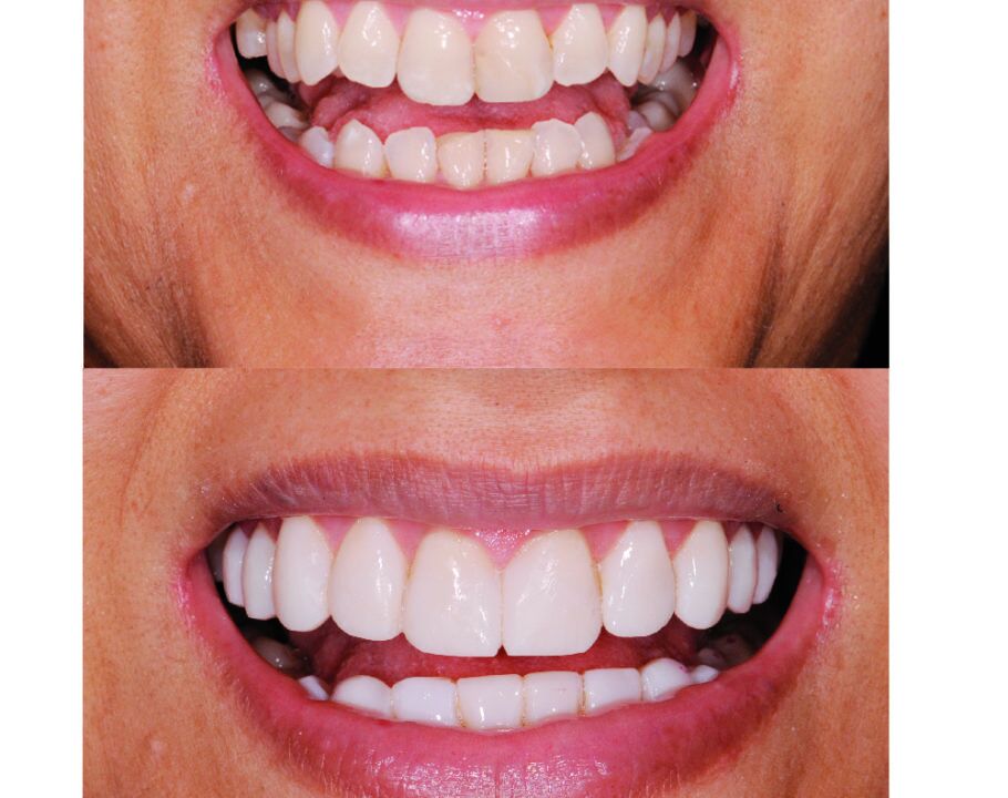 Everything to Know About Dental Bonding, According to Experts