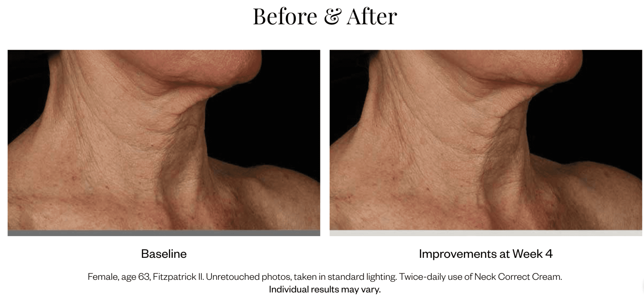Derms Love This Neck Cream for Smoothing Lines—Just Look at the Before ...
