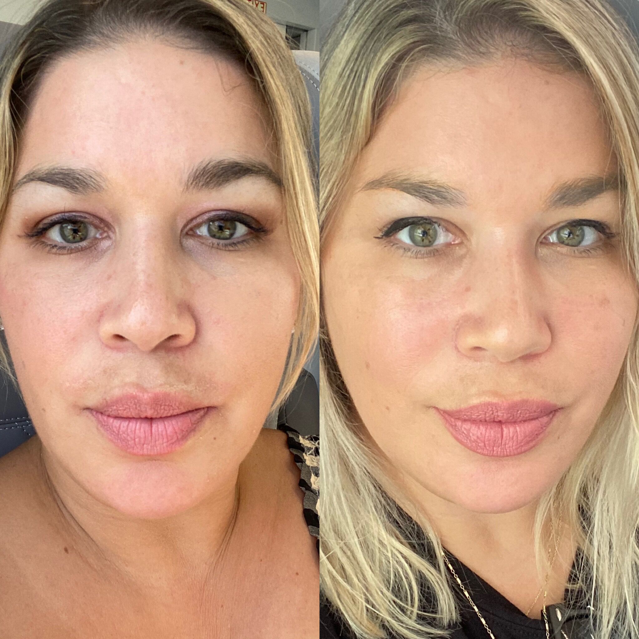 Lasers, Botox or Filler: What Has Worked Best for My Skin at 45