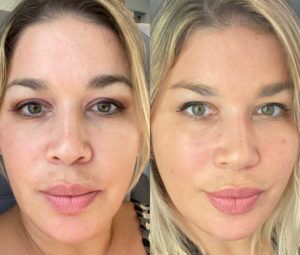 Lasers, Botox or Filler: What Has Worked Best for My Skin at 45