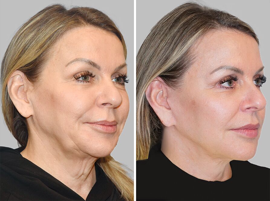 Defying Gravity: Solutions to Firming Sagging Skin