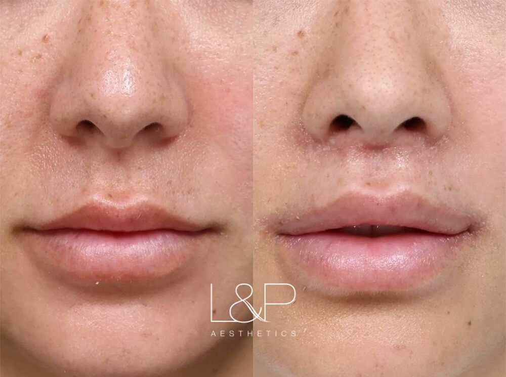 What You Need to Know About the Trending 'Corner Lip Lift' Treatment ...