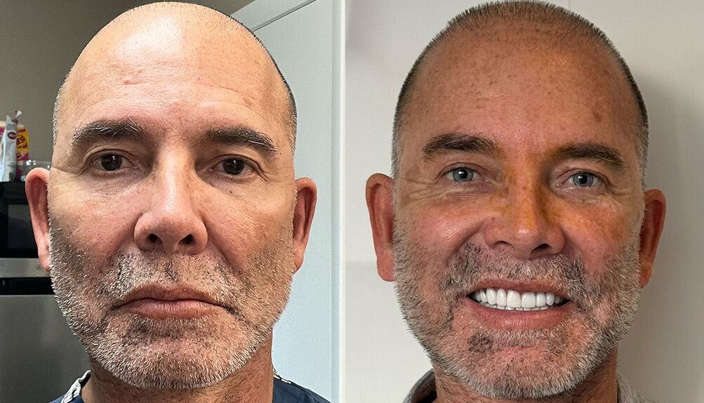 Eye Color Change Surgery: What to Know About the Viral Procedure