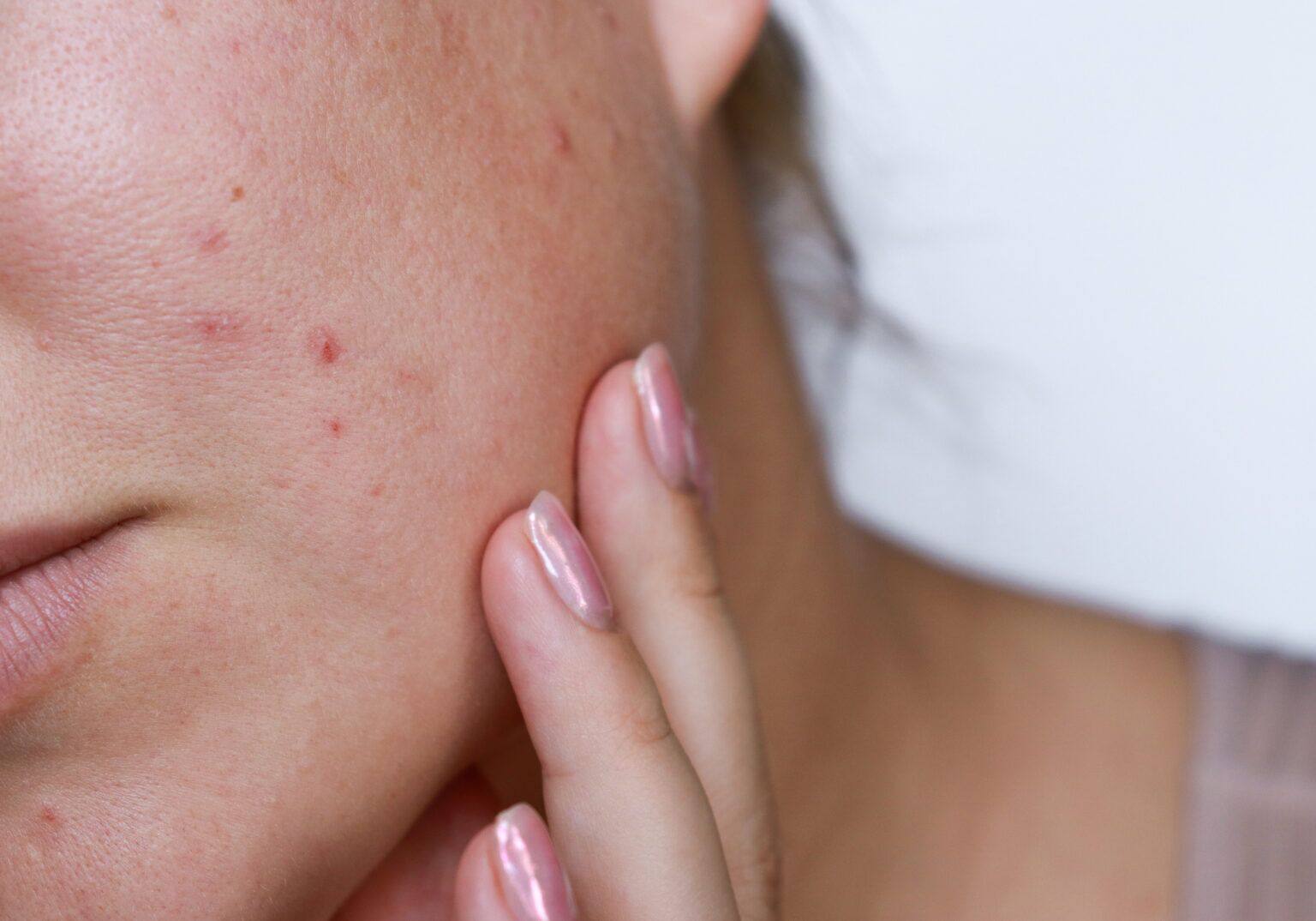 SKin Expert Tips: How to Prevent and Treat Winter Acne