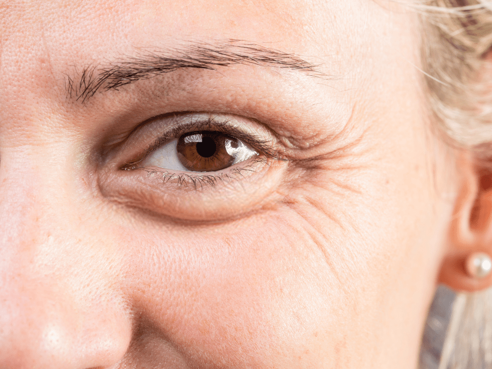 The Secret to Fixing Under-Eye Bags Permanently