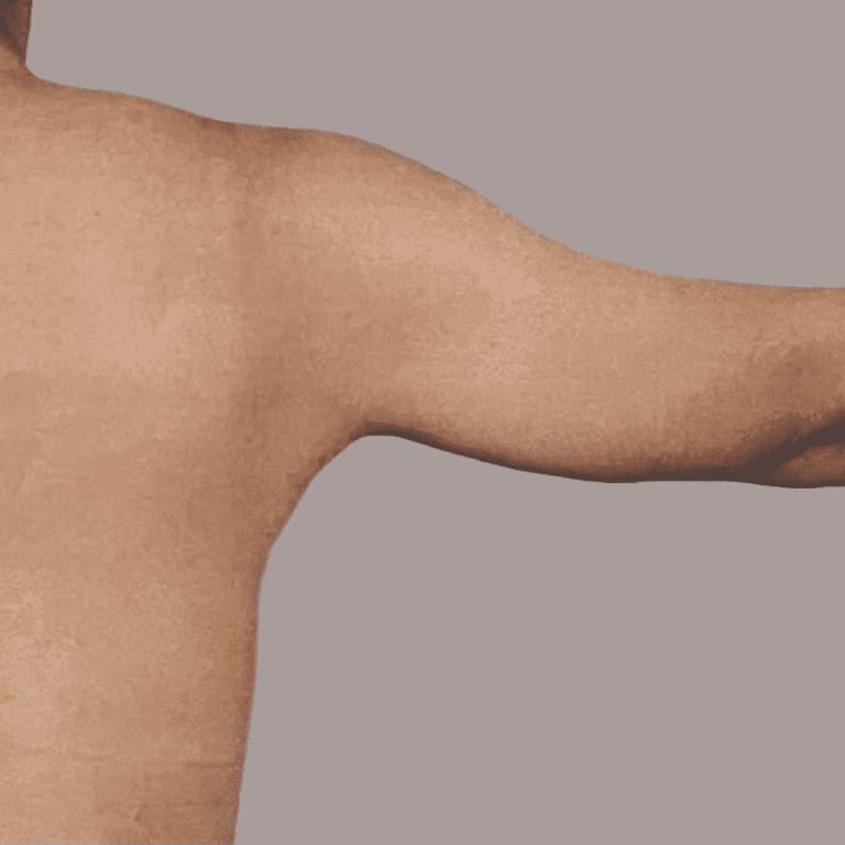 Arm Contouring: A Scarless Way to Gorgeous Arms