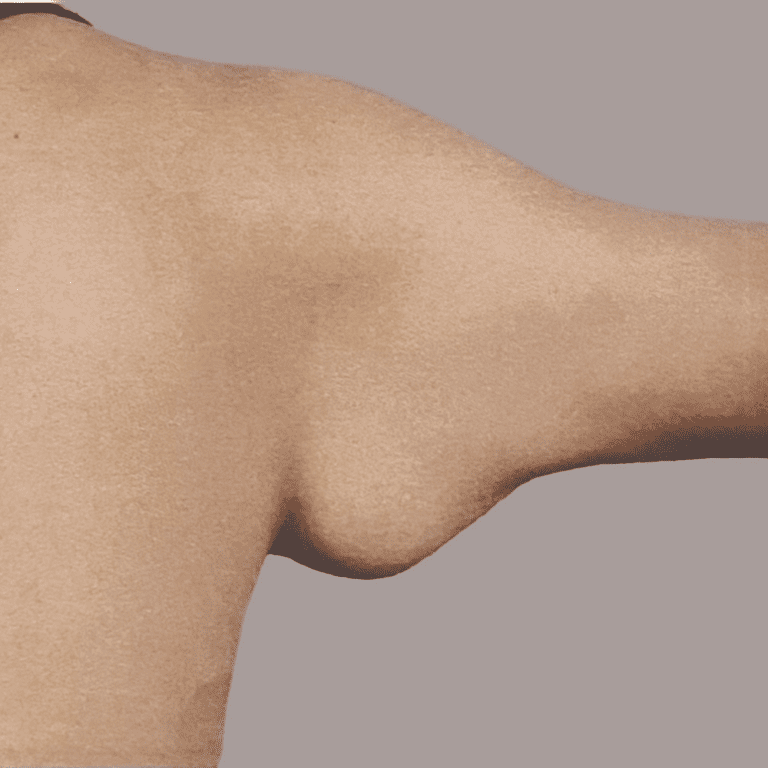 Arm Contouring: A Scarless Way to Gorgeous Arms