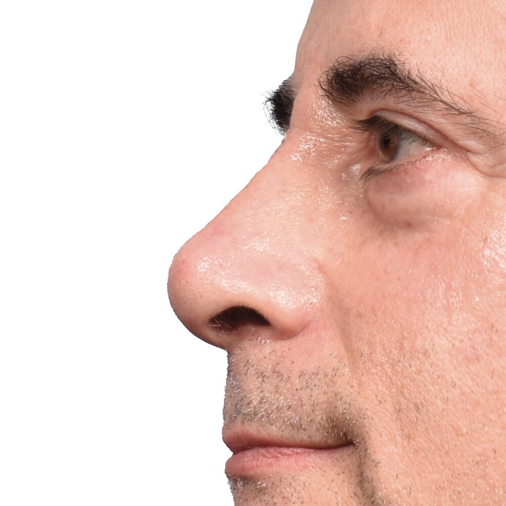 Real Patients Share Life-Changing Rhinoplasty Before-and-Afters