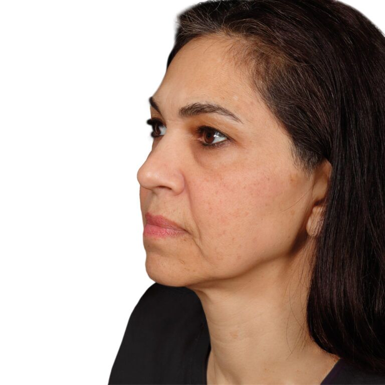 Real Patients Share Life-Changing Rhinoplasty Before-and-Afters