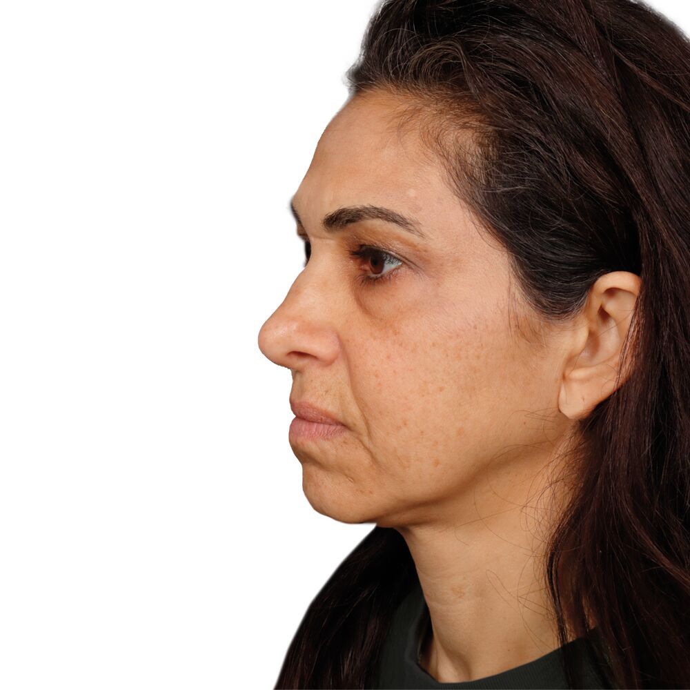 Real Patients Share Life-Changing Rhinoplasty Before-and-Afters