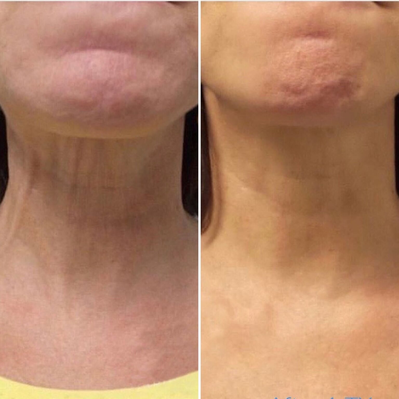 Microneedling Before and After: Your Ultimate Beauty Transformation