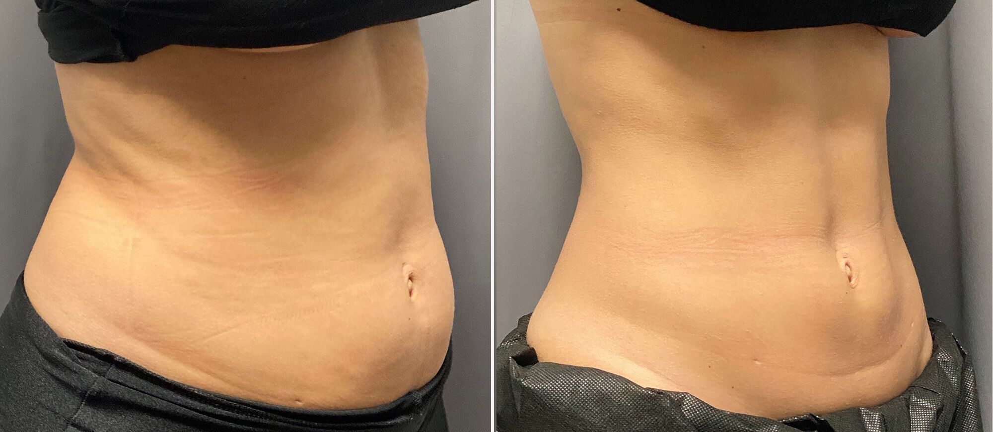 Everyone Is Talking About This Complete Body-Contouring Treatment—and the Before & Afters Speak ...