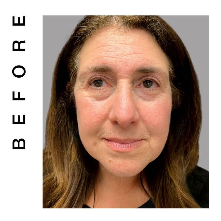 Is Nanofat the New Filler? - NewBeauty