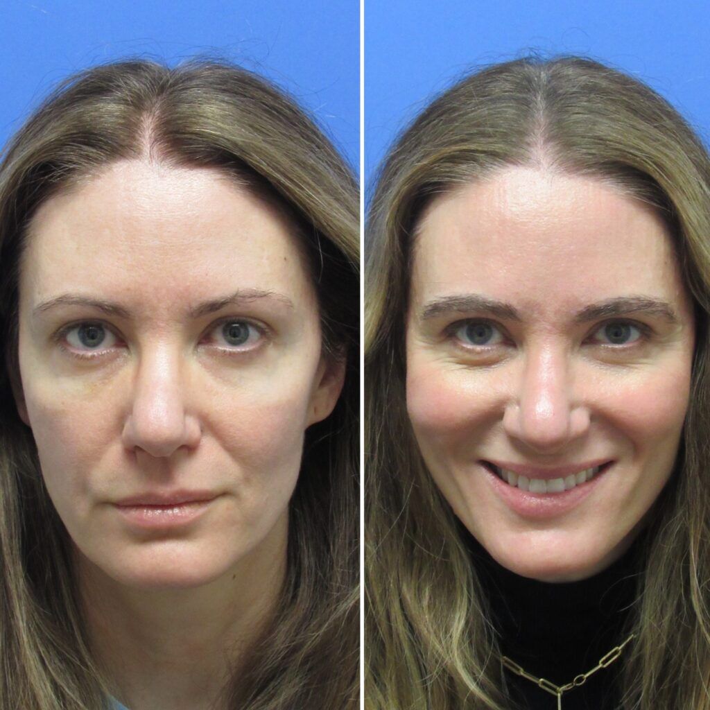 My Eyebrow Transplant Took Years Off My Face