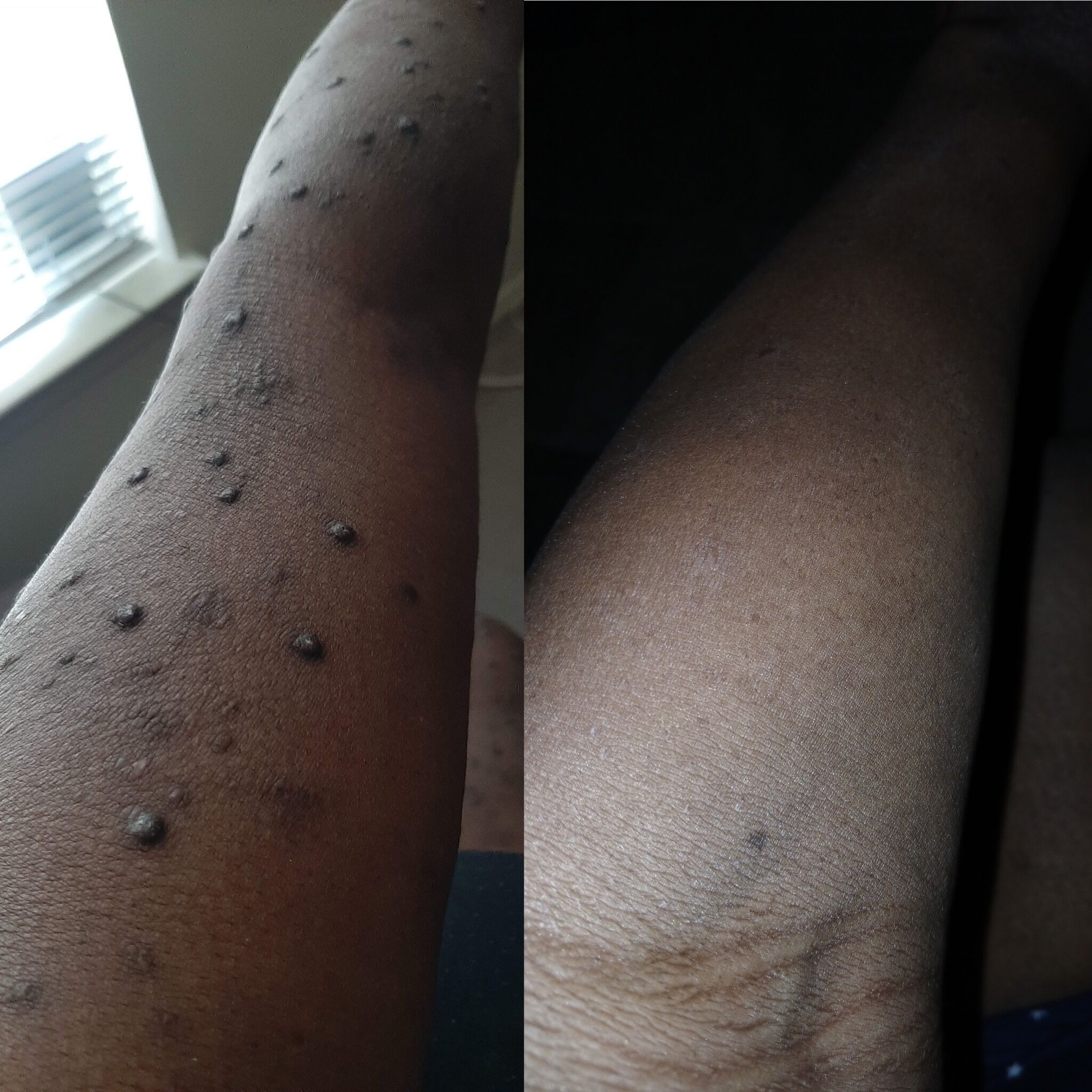 New Drug Relieved Painful, Itchy Skin From Prurigo Nodularis