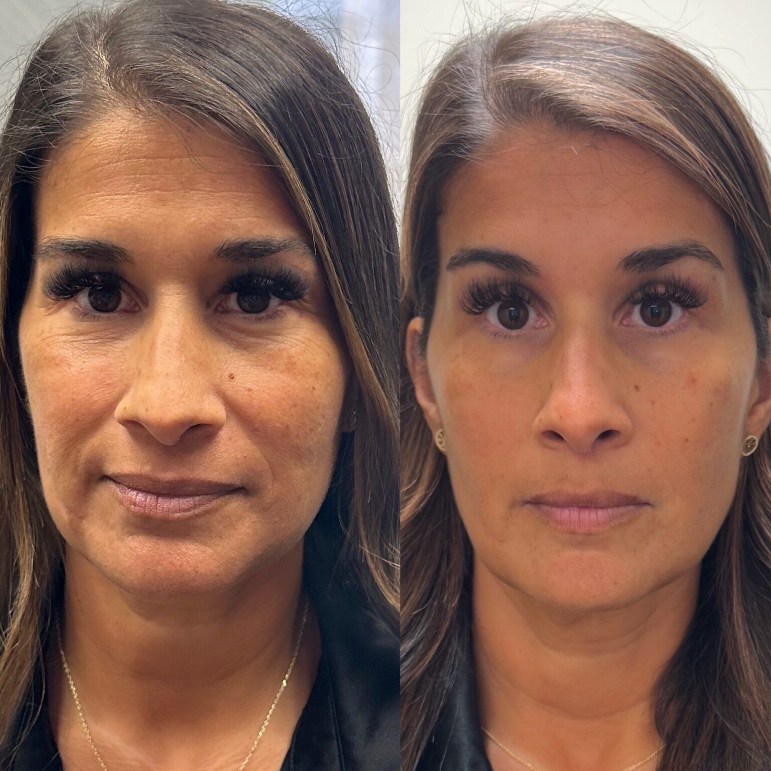 Facial Filler After Weight Loss: Why I Changed My Mind