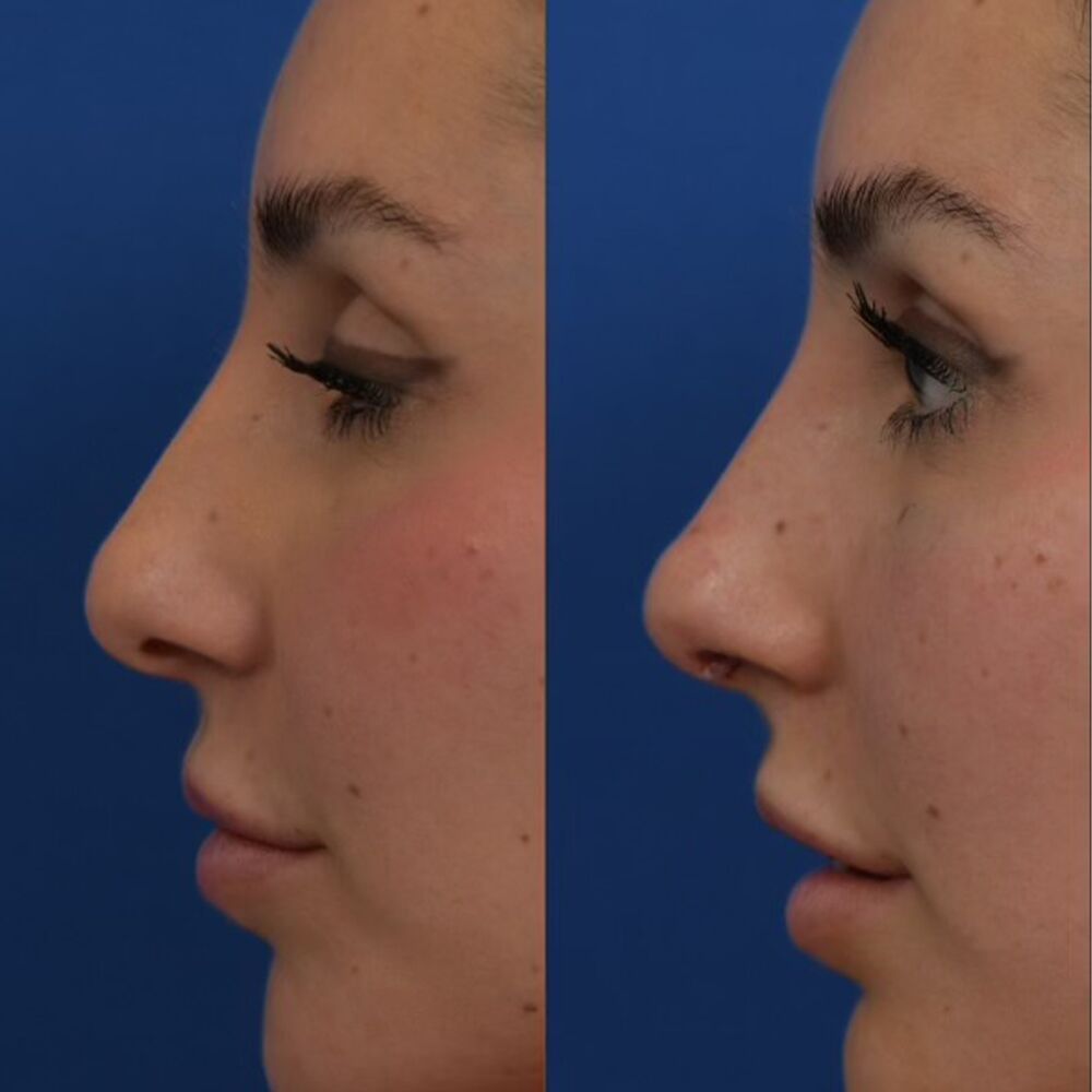 What’s a Tip Stitch, and Can it Replace a Nose Job?