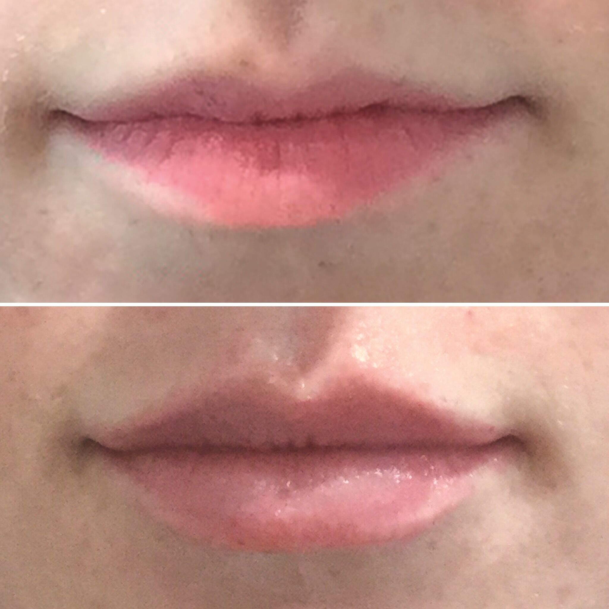 Lip Flip Before and After Gallery - NewBeauty