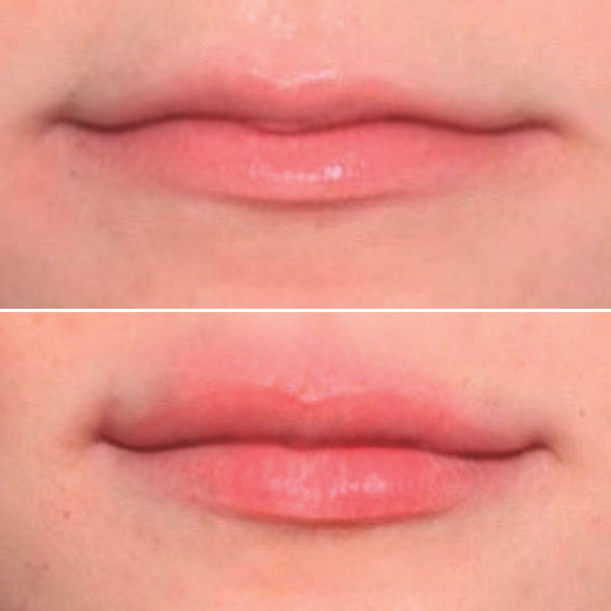 Lip Flip Before and After Gallery - NewBeauty