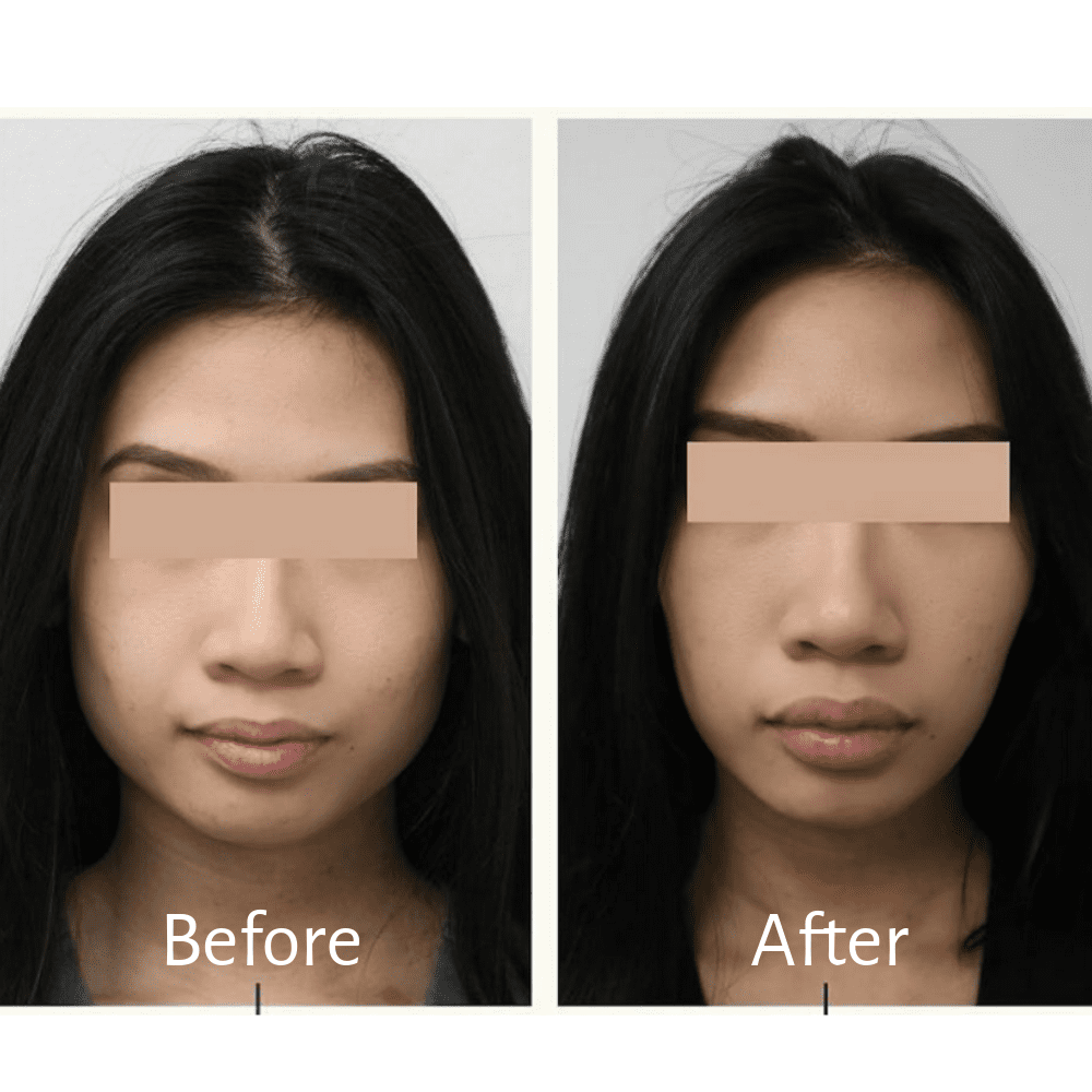 Masseter Botox Gallery: Before and After - NewBeauty