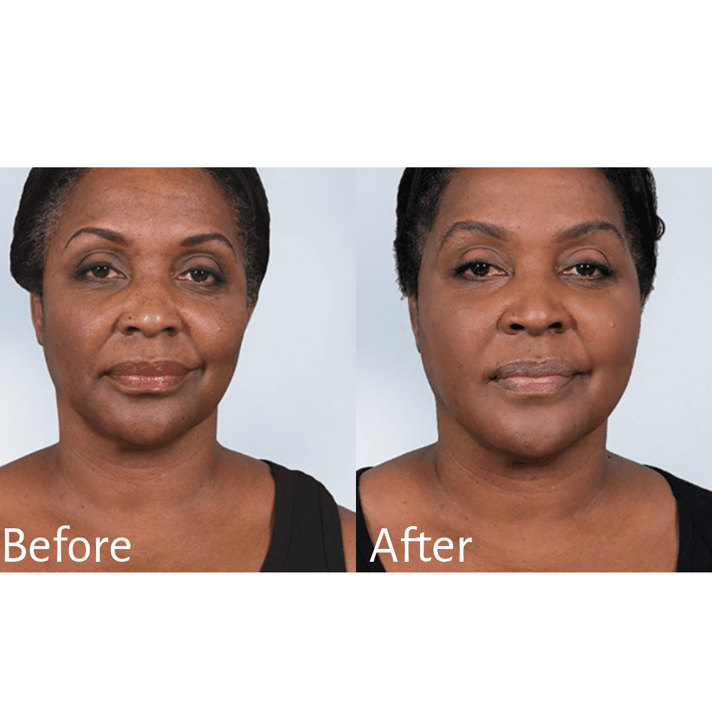 Sculptra Before and After: Results Gallery
