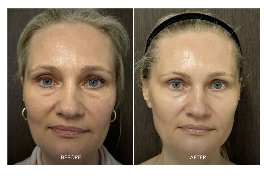 The $685 Laser Loved By Lindsay Lohan and Julianne Moore