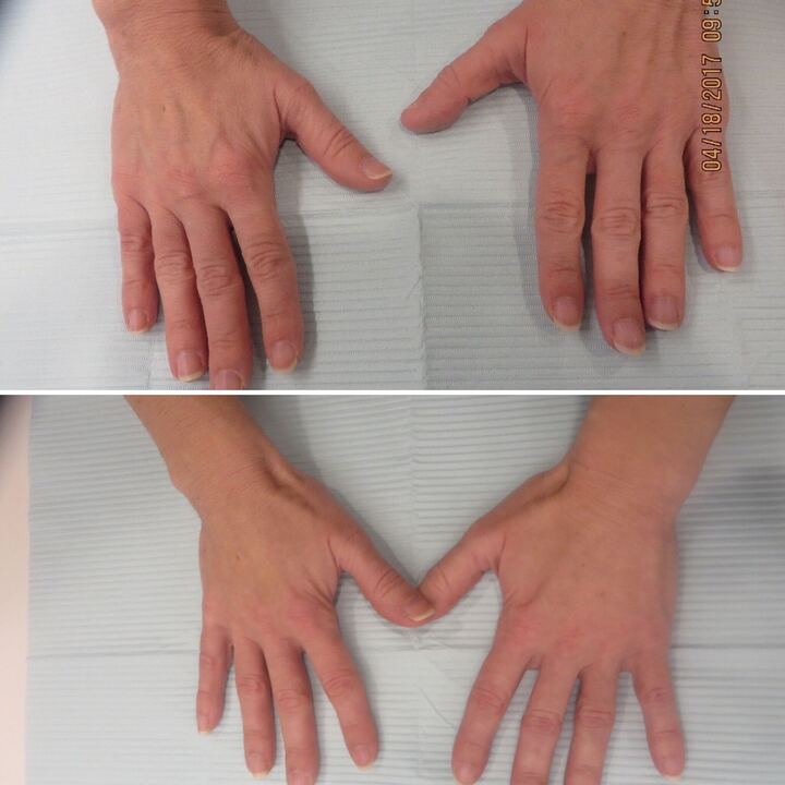 Transform Aging Hands With Expert Hand Filler Solutions